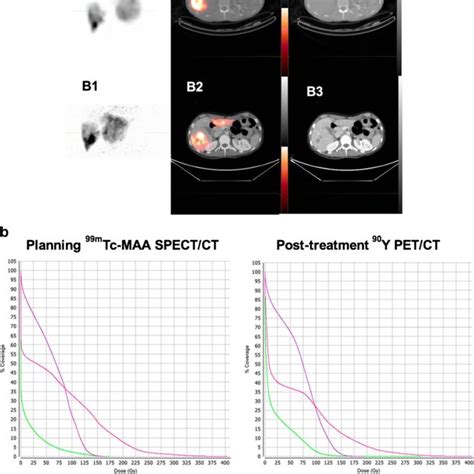 Forty Six Year Old Woman Patient With New Hepatic Metastases In Liver Download Scientific