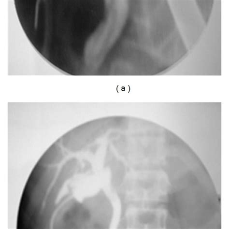 A Mrcp—hypointense Tubular Filling Defect In Cbd And Chd B Download Scientific Diagram