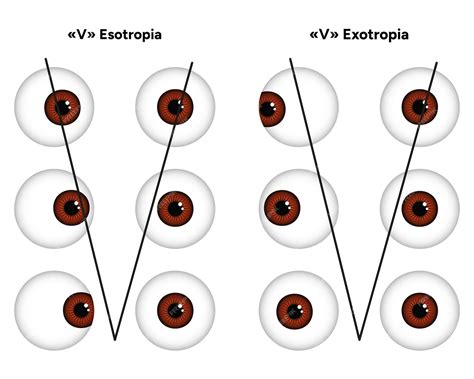 Premium Vector Types Of Strabismus V Esotropia And V Exotropia