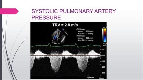 Echo Assessment RV Function By Dr Amit Pptx