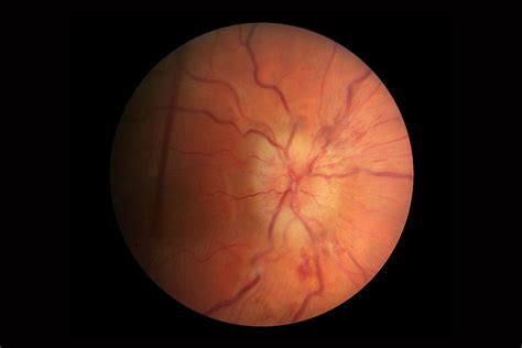 50 Facts About Papilledema