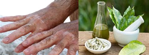 Drdo Scientist Develops Herbal Drug To Treat Leucoderma Disease The