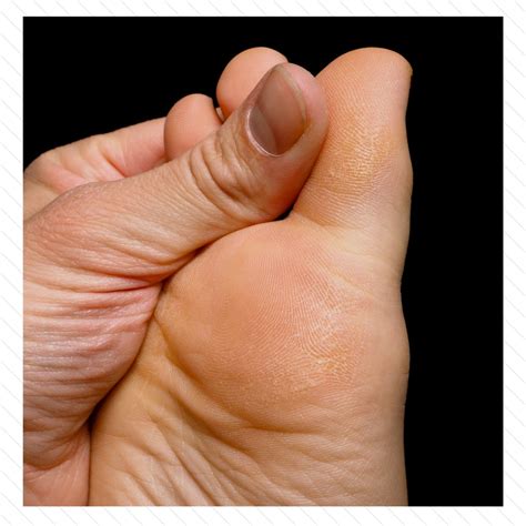 무지외반증 증상 및 실리콘 발가락 교정기 무지외반증교정기 네이버 포스트