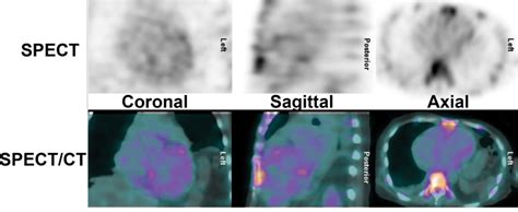 99mtc Bone Avid Tracer Cardiac Scintigraphy Role In Noninvasive