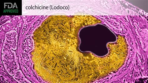 Colchicines Rebirth As Cardiovascular Drug Approved By Fda Medpage Today