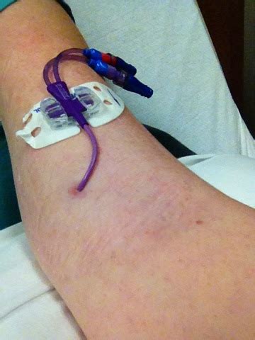 Considering Public PICC Line Pointers