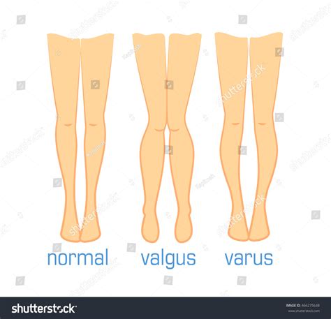 Vector Medical Illustration Human Leg Curvatures Stock Vector Royalty