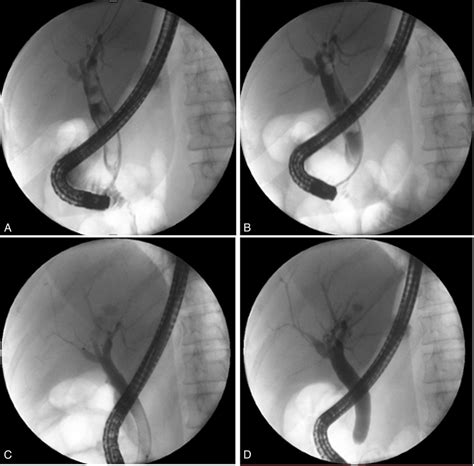 A And B Fluoroscopy In Retrograde Endoscopic Cholangiography