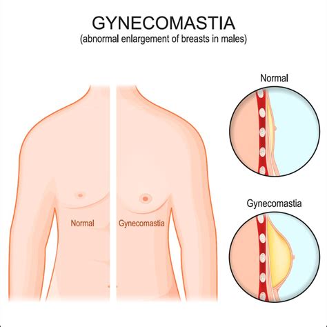 Gynecomastia Causes Risk Factors Symptoms Treatment