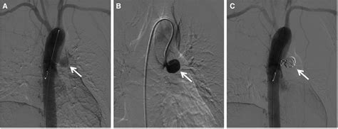 Intraoperative Angiogram Displayed A The Anterior Wall Location Of
