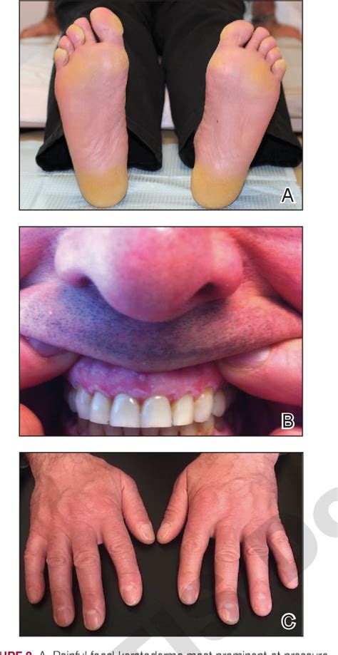 Figure 2 From Focal Palmoplantar Keratoderma And Gingival Keratosis Caused By A Krt16 Mutation