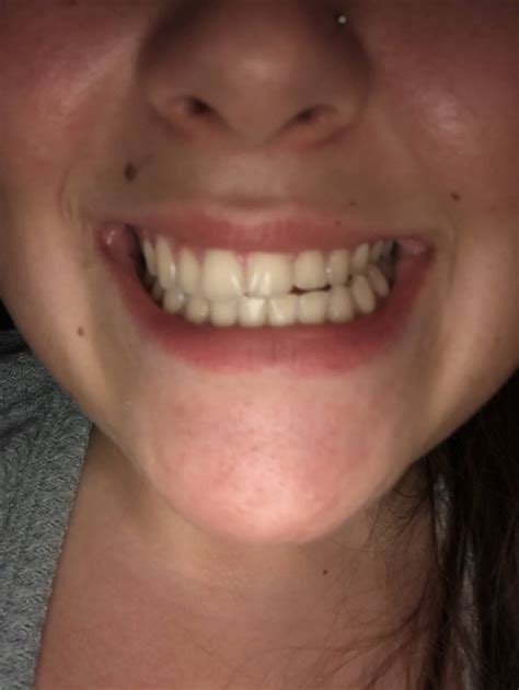 Crossbite Teeth Braces