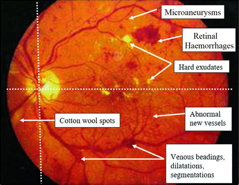 Retinal Scans Model Why We Do Retinal Scans