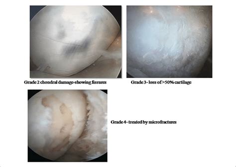 Grading Of Severity Of Chondral Damage On The Basis Of Outerbridge Download Scientific Diagram