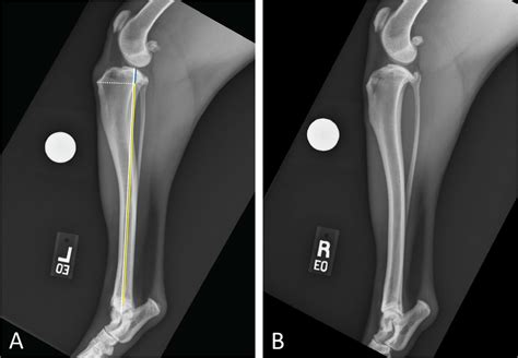 Migration Of Broken Tibia Plateau Screws