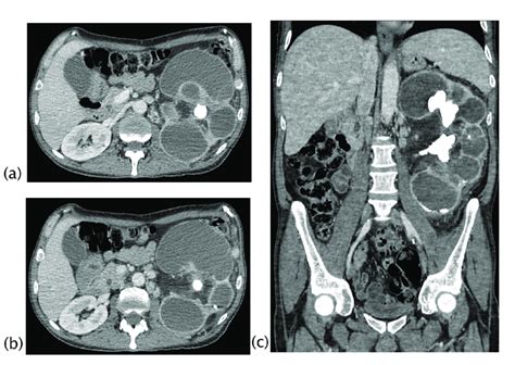Xanthogranulomatous Pyelonephritis Stage I Nephritic Form Ct With Download Scientific Diagram