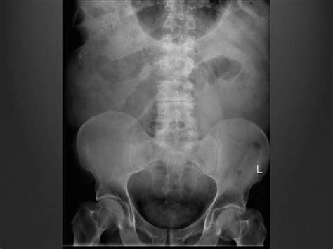 Approach To Pfa Interpretation Pptx Digestive Disorders Diseases And Conditions