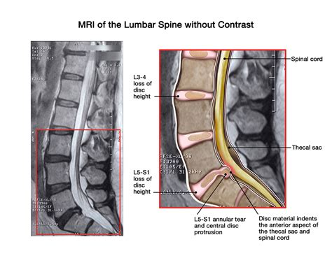 Magnetic Resonance Imaging Of Lumbar Spine Archives Jackie Heda Biomedical And Scientific Visuals