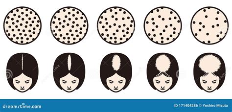 Female Pattern Hair Loss Set Stages Of Baldness In Women Stock Vector
