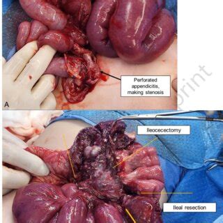 Operative Findings On Day 4 The Perforated Appendix Adheres To The Download Scientific Diagram