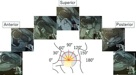 Positions Used To Measure The Labral Parameter Position Of Each Of The Download Scientific