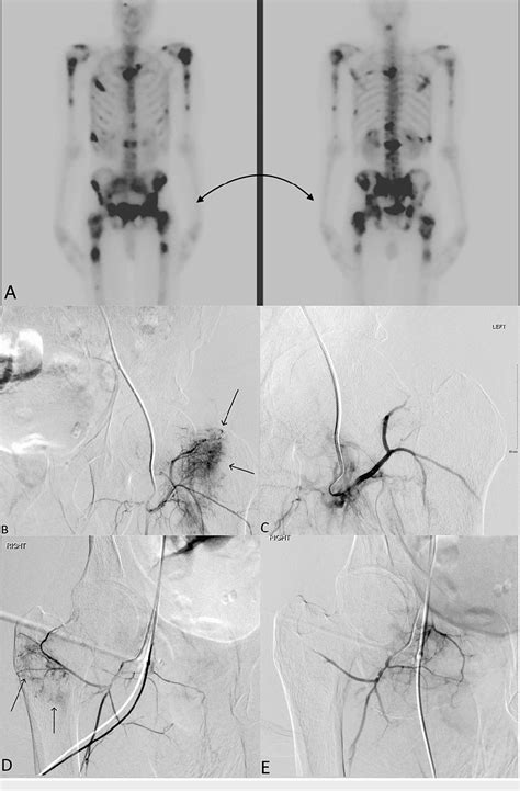Figure 2 From Embolization Of Renal Cell Carcinoma Skeletal Metastases Preceding Orthopedic
