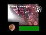 Laparoscopic CBD Exploration Right Hepatic Duct Impacted Stone Extraction Video MEDtube Net