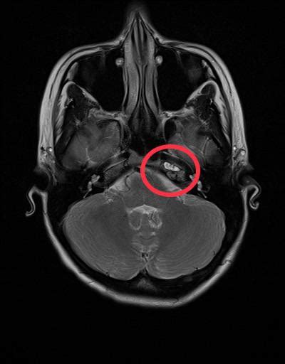 My Mri Of My Cholesterol Granuloma Rxrayporn