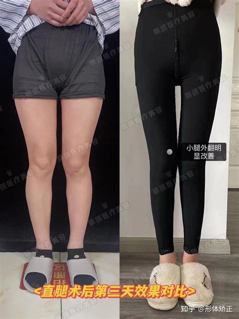 卢九宁直腿成形术怎么做的呢到底有没有让腿变直的手术呢 知乎