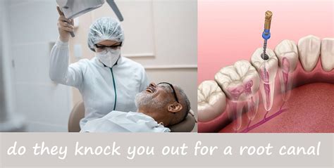 Do They Knock You Out For A Root Canal