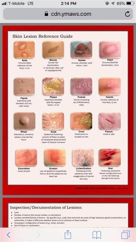 Skin Lesions Chart