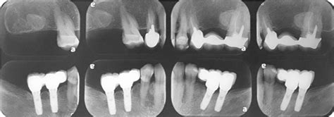 Exostosis Dental