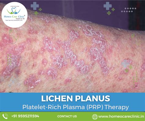 Lichen Planus Causes
