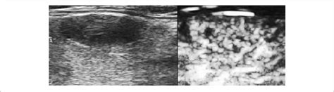 On The Left Side A Gray Scale Us Image B Mode Of The Lymph Node In