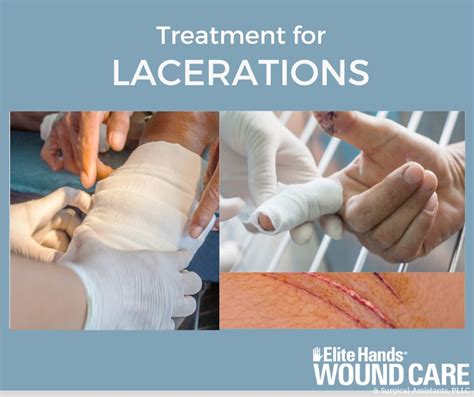 Woundcare Lacerations Wound Care Nc Pllc