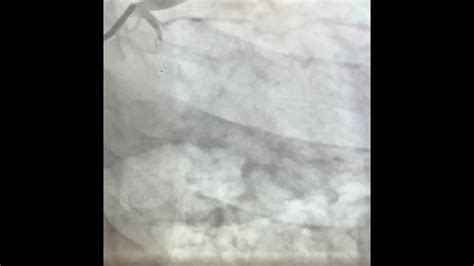 50yr M With Nstemi Lhc Shows Prox Lcx Subtotal Cross With Runthrough… Ussama Munir