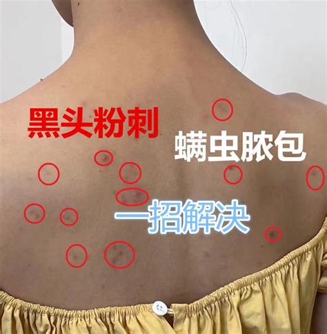 痘痘、脓包在身上反反复复？过来人手把手教你，在家就能祛痘！ 知乎