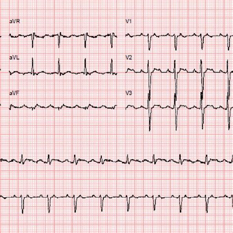 Electrophysiology Study Demonstrating Conversion Of Left Atrial Flutter Download Scientific