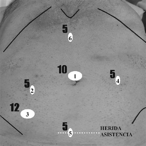 Pdf Restorative Proctocolectomy With An Ileoanal Pouch The Role Of