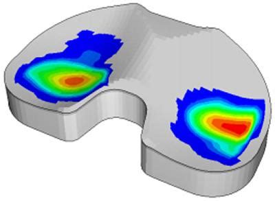 Finite Element Simulation Of Surface Wear In Total Knee Joint Replacement Engineering