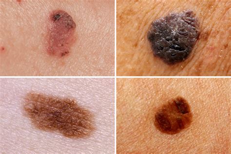 Using Dermoscopic Features To Diagnose Melanoma In Situ Contemporary Approaches To Malignant