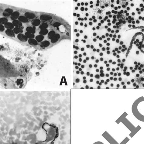 A Pelvic Radiograph Showing Small Calcific Nodule B Fistulogram Download Scientific