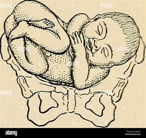 Shoulder Presentation