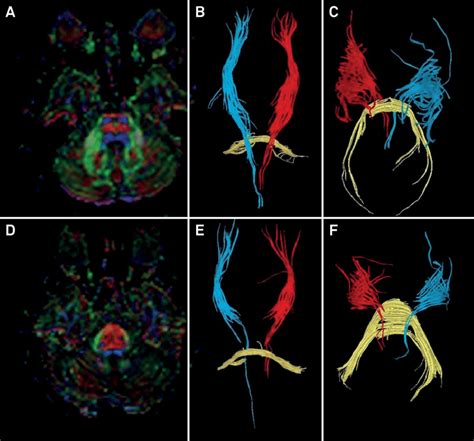 Diffusion Tensor Imaging Tractography In Arsacs Fractional Anisotropy