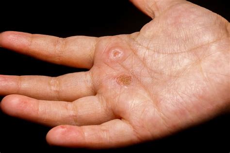 Shingles On Palms Of Hands