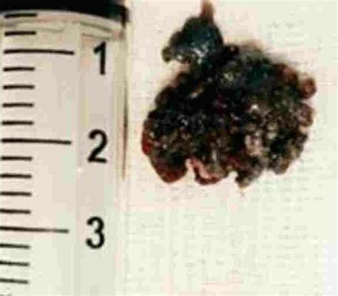 Normal Tympanic Membrane After Excision Of The Mass Download