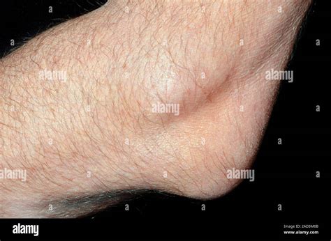 Bursitis Of The Elbow Close Up Of The Inflamed Elbow Olecranon Of A