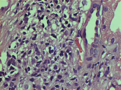 Glomeruli Showed Moderate Mesangial Matrix Accentuation With Hyper