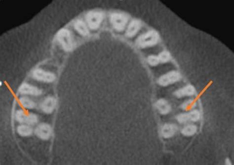 Presence Of Mb2 Canals In Maxillary Second Molar Teeth Download