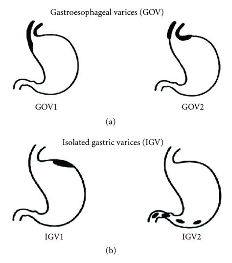 Sarin Classification Of Gastric Varices Download Scientific Diagram